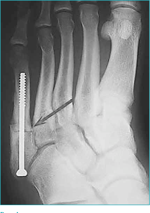 Fraturas do Pé e Tornozelo – Dr. Eduardo Fanchin Rocha