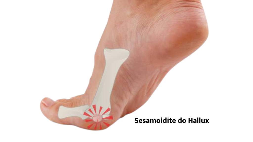 Hallux Rigidus: Sintomas e tratamentos – Dr. Eduardo Fanchin Rocha